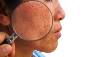 Hipercromias (Manchas na Pele) - O que são e como tratar