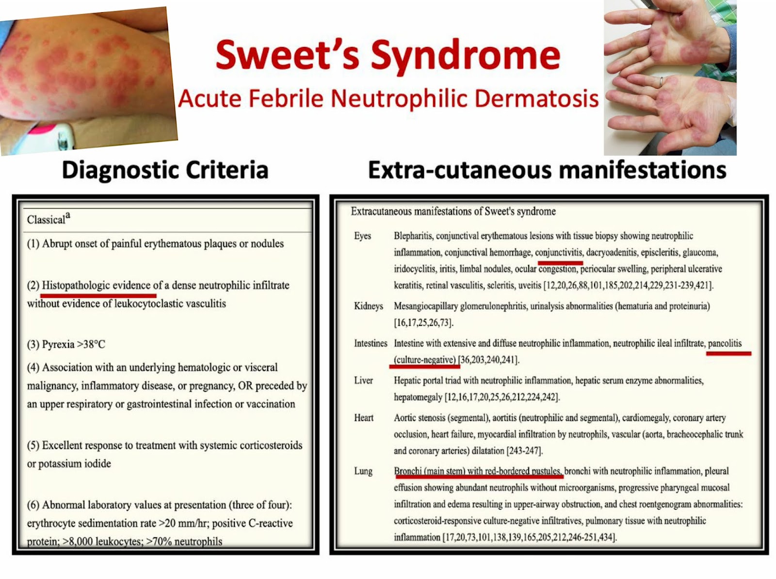 Sweet's Syndrome - Acute Febrile Neutrophilic Dermatosis