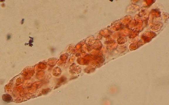 Sedimento urinario: Cilindros