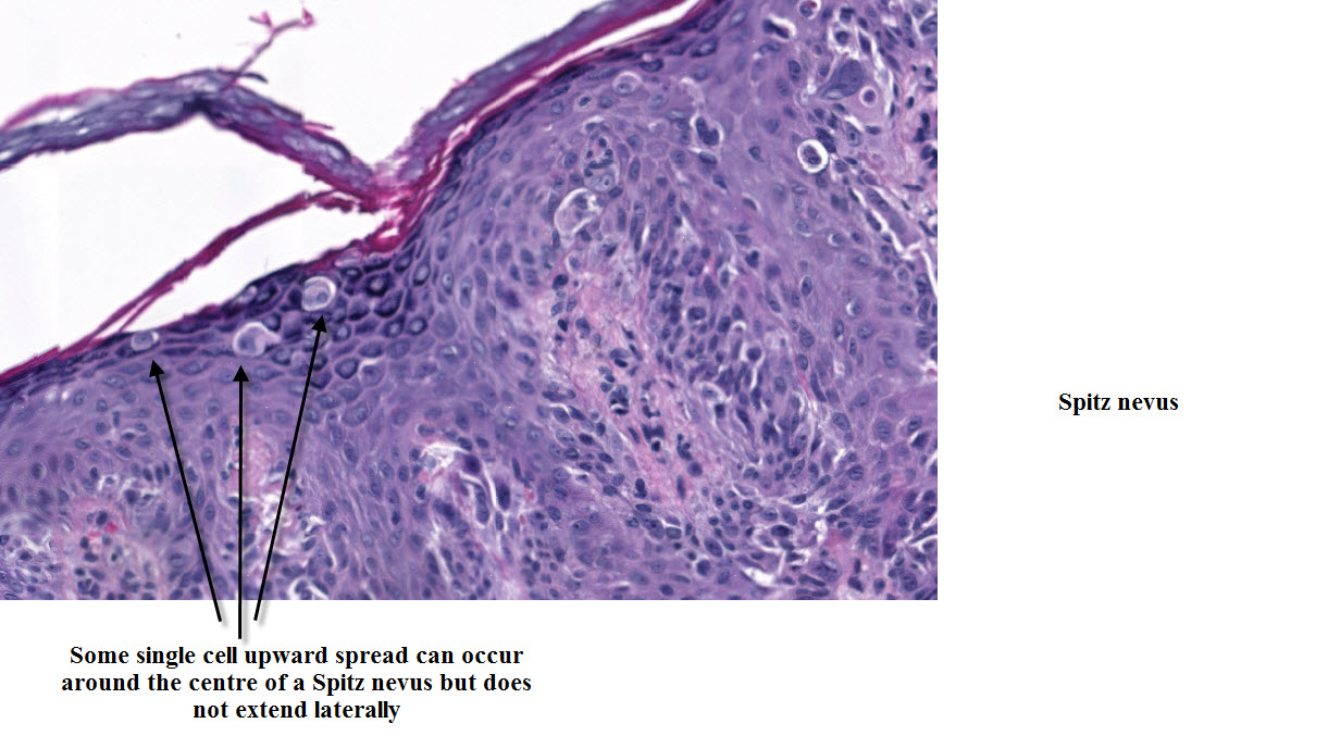 Dermpath Made Simple - Neoplastic: Spitz Nevus and Reed Nevus