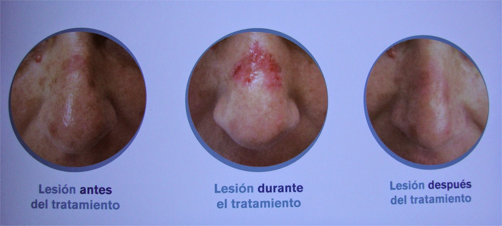 Dermatología-Madrid: ACTIKERALL ® (5FU + SALICÍLICO): NUEVO TRATAMIENTO ...