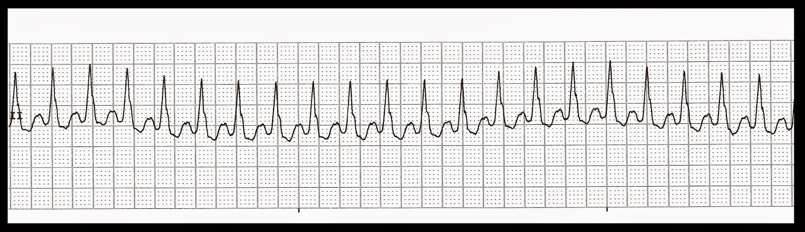 Practice EKG Strips 219