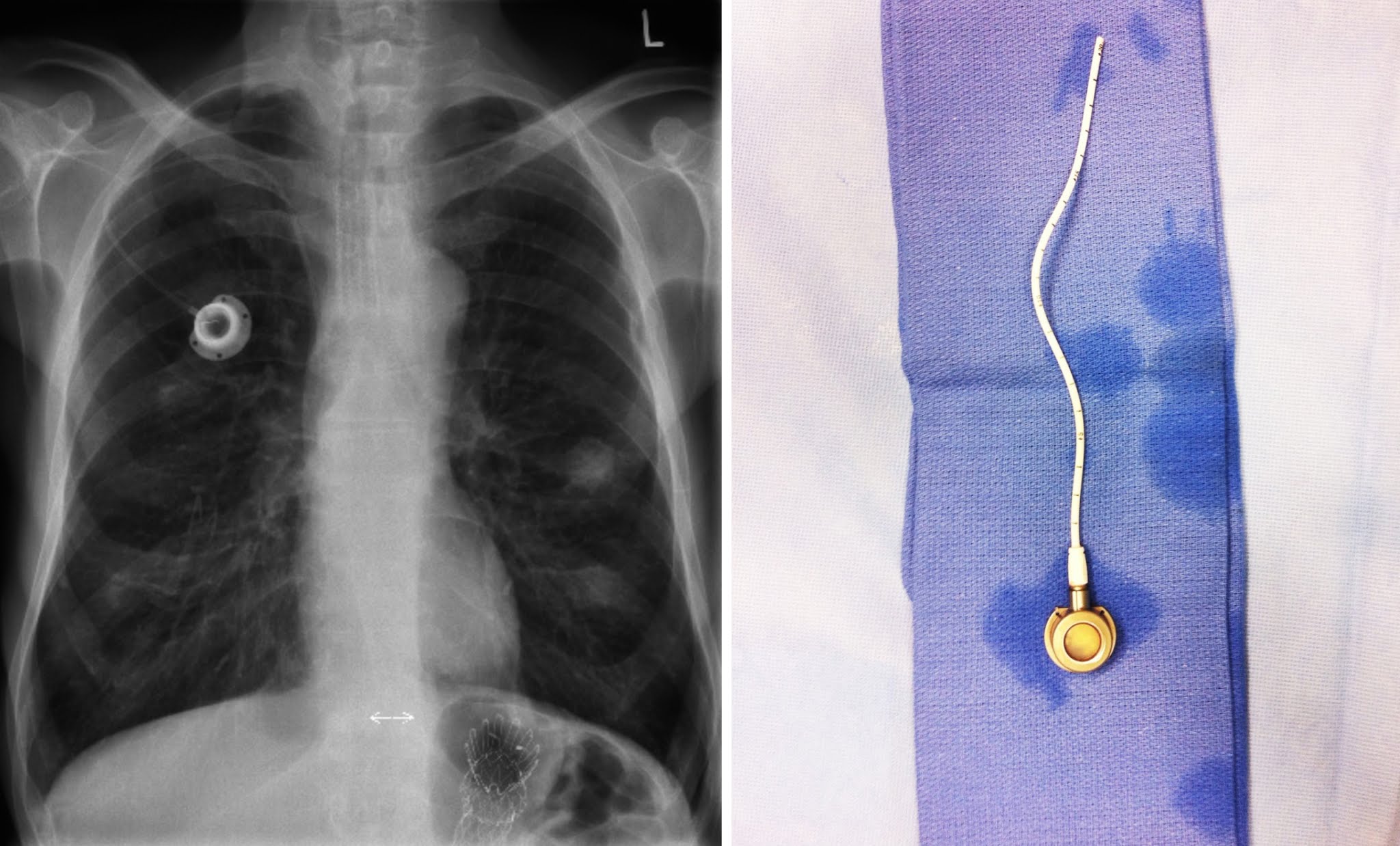 What to Expect when Getting an Implanted Port & Bone Marrow Biopsy for ...