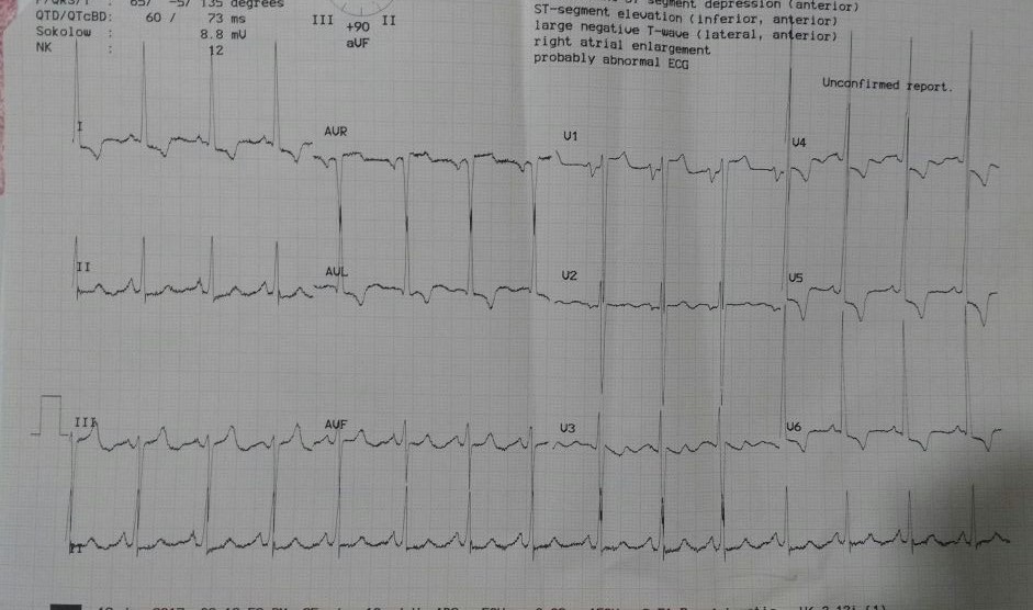 Cardiology window: ECG Left ventricular hypertrophy ? What is your ...