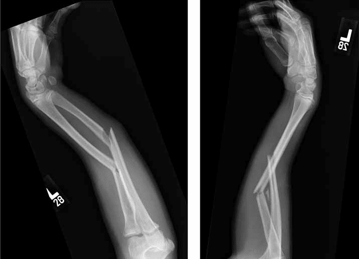 Fracture Both Bones Of The Forearm Tips Health 24 Hours