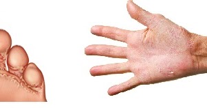 Alipunga or Athlete's Foot ~ What's New Philippines?