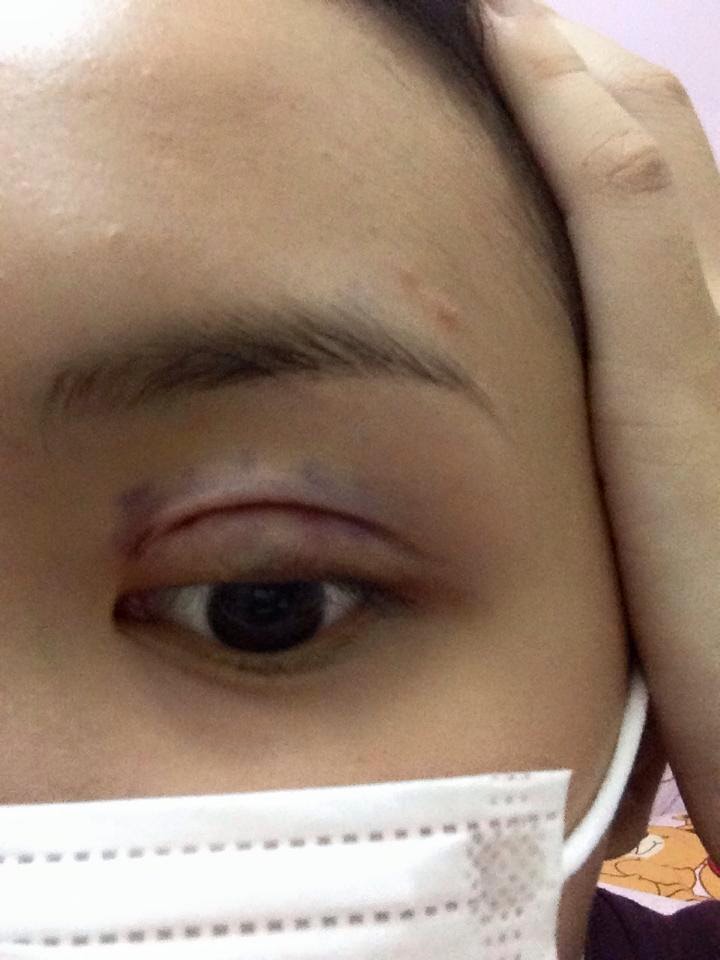 Eyelid Stitching Part 2: Recovery process - KWG's