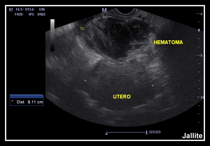 Hematoma Post-Cesarea