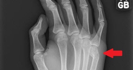 EmergencyMedJC: Buddy taping vs. Plaster for Neck of 5th Metacarpal ...