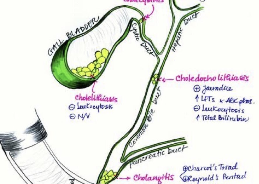 ZONA DE SALUD DE OFRA: Patología biliar: colelitiasis, colecistitis ...