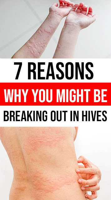 7 Reasons Why You Might Be Breaking Out in Hives - wellness magazine