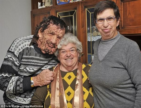 Touching story: Pope embraces man with a disfigured face ~ Osa's eye ...