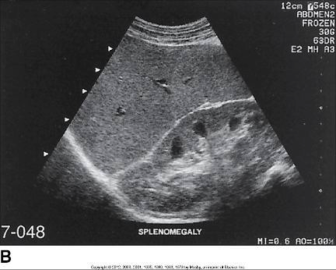 MEDICAL ULTRASOUND/SPLENOMEGALY