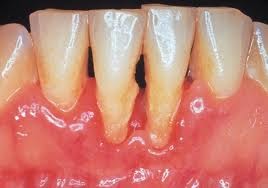 bbdent pluss: periodontitis agresiva localizada