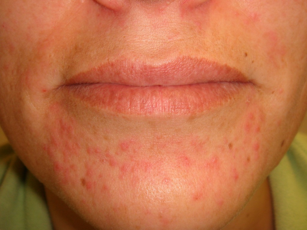 Sintomas De Dermatite Perioral - RETOEDU