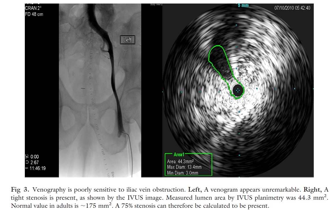 Chronic Venous Insufficiency and Lymphedema : Venous Lymphedema