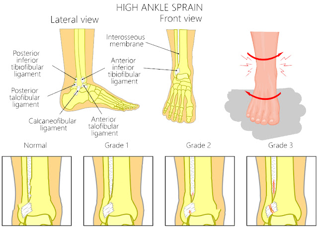 Syndesmosis (High Ankle Sprain) Injuries: Scientific Rehab