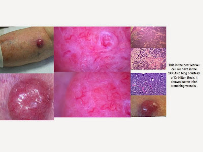 Dermpath Made Simple - Neoplastic: Merkel Cell Carcinoma