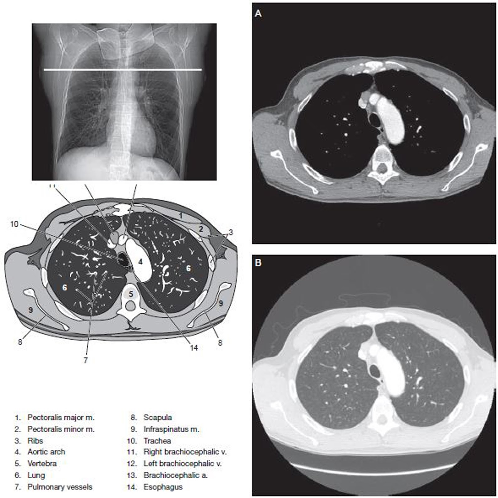 Heart Ct Scan Labeled