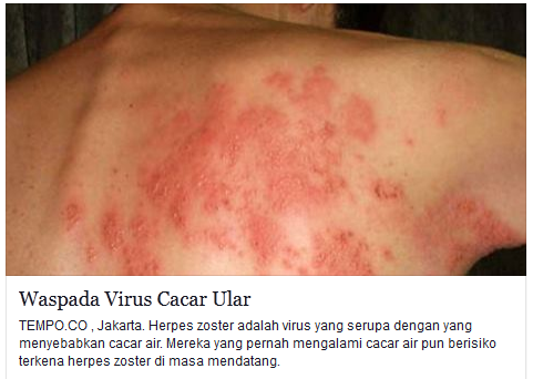 Waspada Virus Cacar Ular | Kumpulan Berita Harian