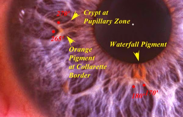 Modern & Multidimensional Iridology: Orange Pigments at Pupillary Zone ...