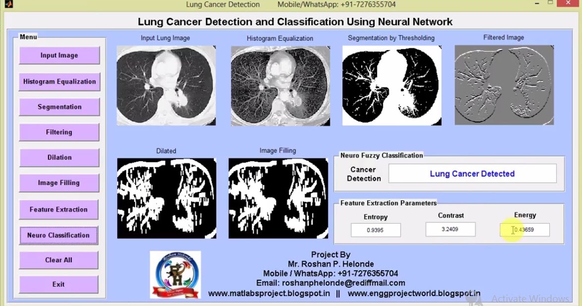 Matlab Project Lung Cancer Detection Using Neural Network Full Source