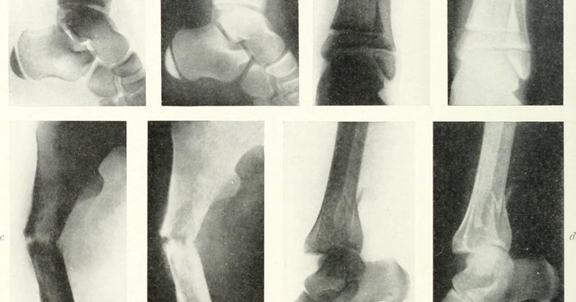 Open Fracture Symptoms - Treatment | Surgery | Healing Time