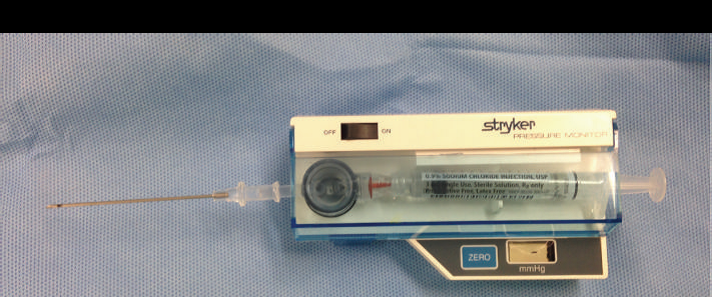 Kumpulan Kasus Medis: Sindroma Kompartemen di bidang Orthopedi