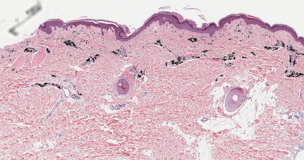 Differential Diagnosis in Dermatopathology: Black staining