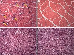 Muscle Cancer, Prone Attack Children