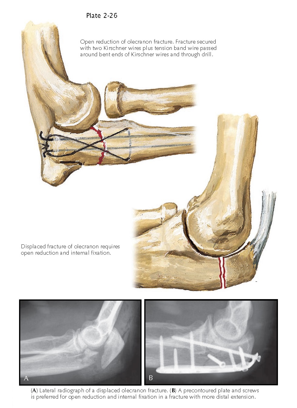 FRACTURE OF OLECRANON - pediagenosis