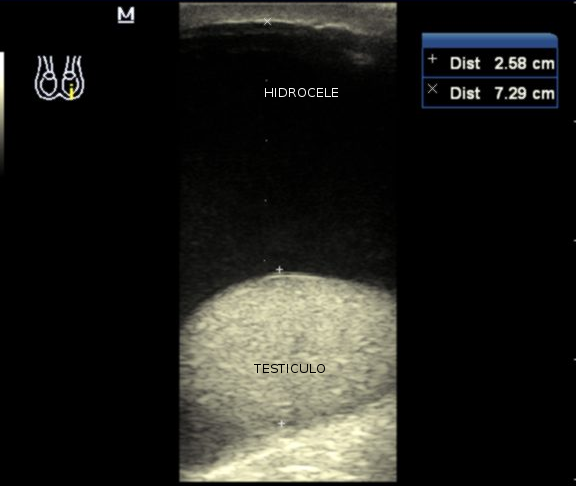 EcoCyl-Grupo: Hidrocele