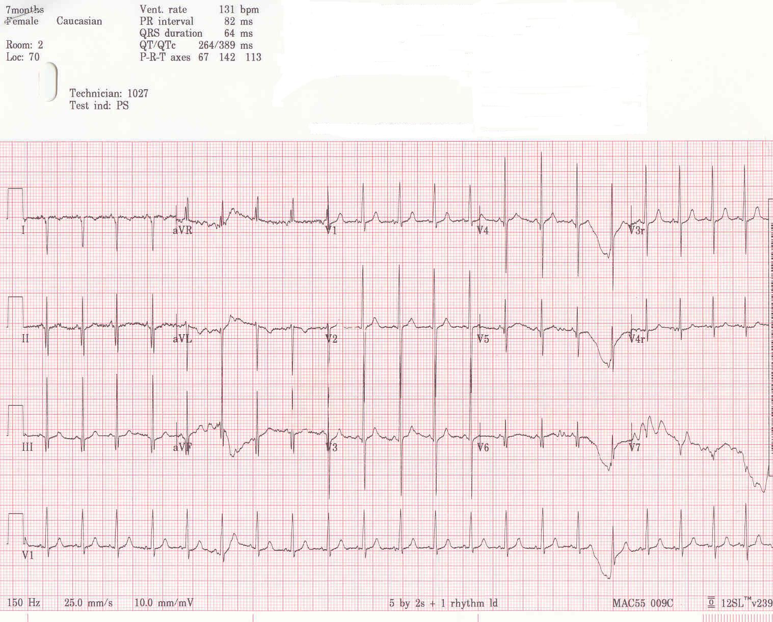 Pedi cardiology: EKG: RVH with strain - 7 month old