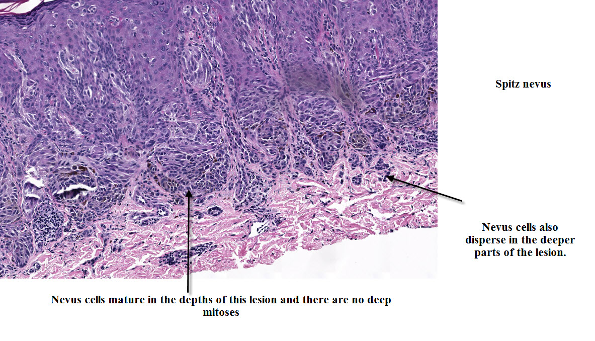 Dermpath Made Simple - Neoplastic: Spitz Nevus and Reed Nevus