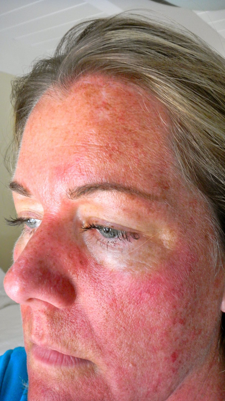 Efudex and Me 2013: Efudex Day Ten