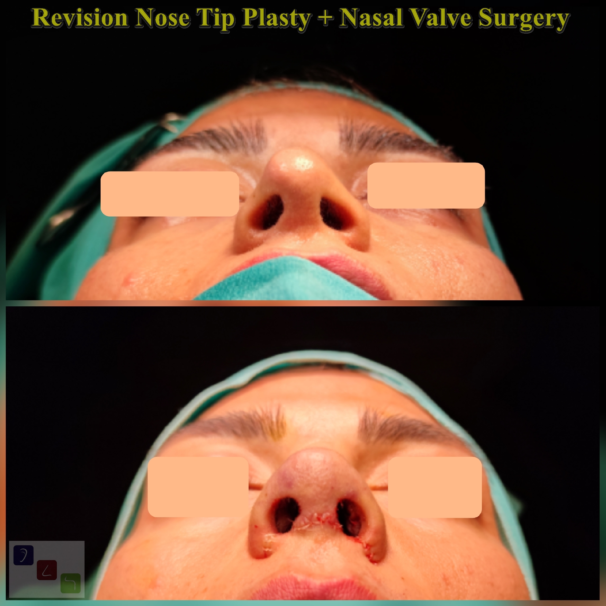 Revision Nose Tip Plasty in Istanbul