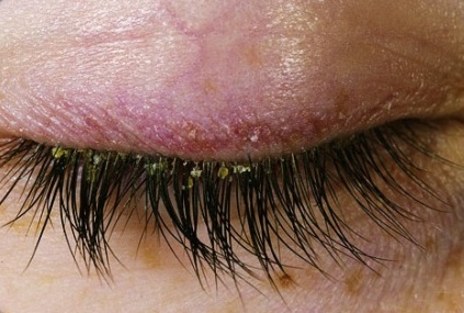 Imágenes de Salud: Imágenes de la dermatitis seborreica