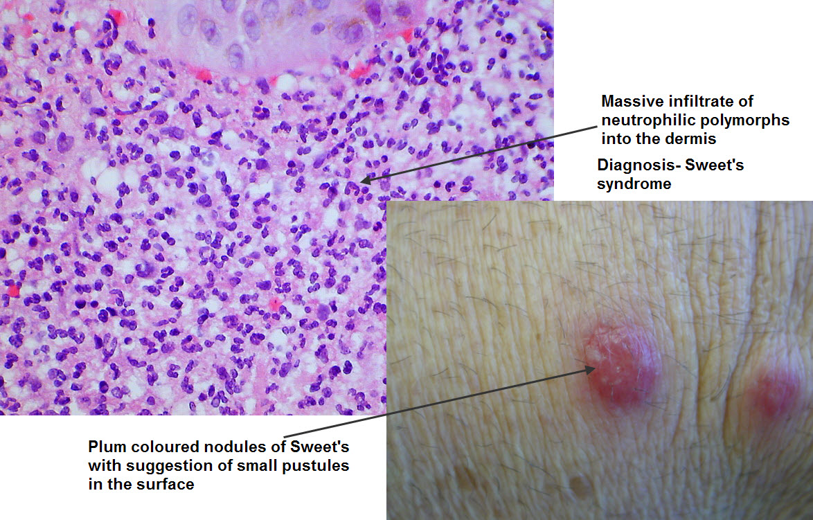 Dermatopathology Made Simple - Inflammatory: Infiltrates of Cells or ...