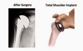 Medical Treatment Pictures-for Better Understanding: Shoulder ...