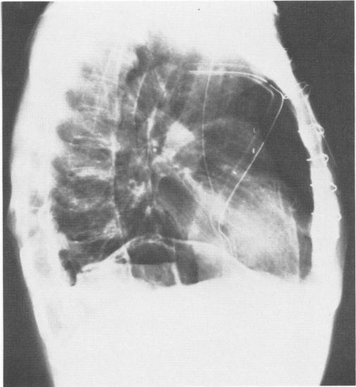 Centro de Terapia Semi-Intensiva Hospital de Clínicas - UFPR: TÓRAX DE ...