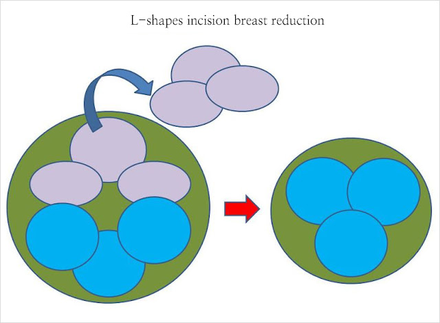 Dr. Lee Breast augmentation Korea: Breast reduction Seoul - vertical ...