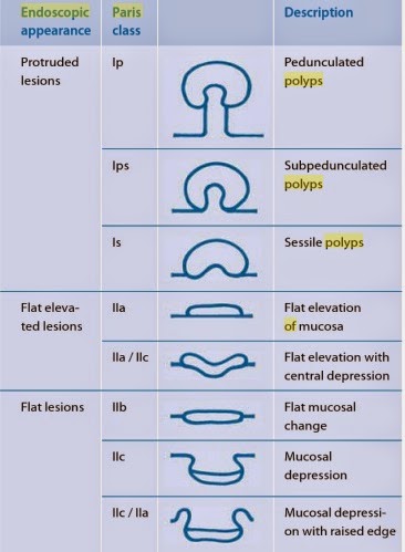 My Gastro Room: The Paris endoscopic classification of polyps
