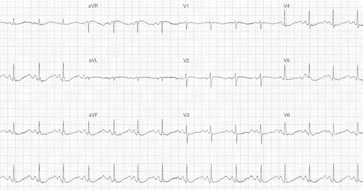 ECG of the Week: ECG of the Week - 13th November 2017
