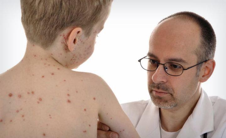 Guía de enfermedades pediátricas 2020/2021: SARAMPIÓN. Definición.