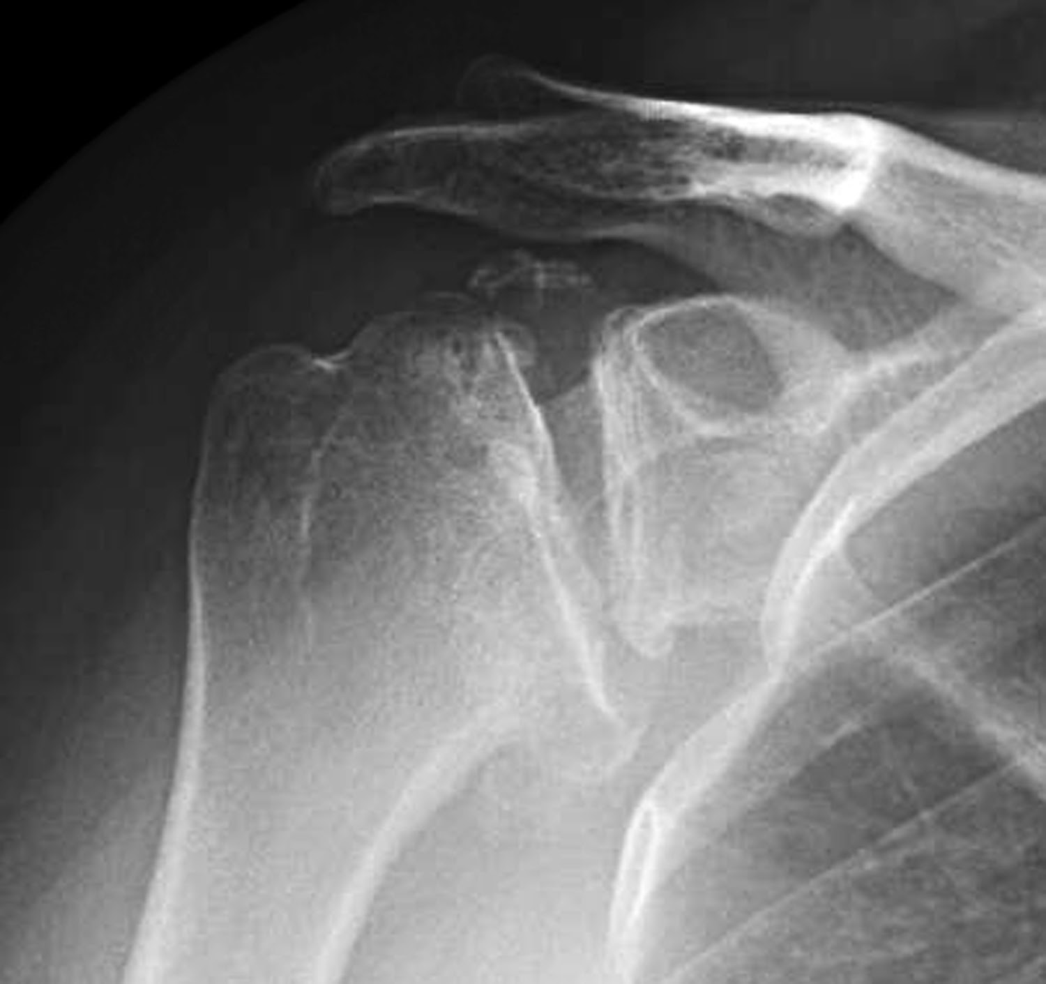 UW Shoulder and Elbow Academy: Shoulder joint replacement - many ...