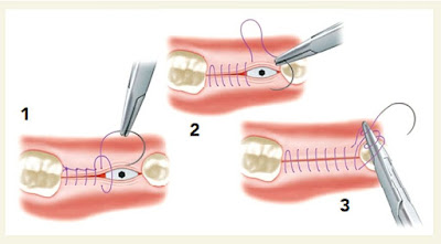 PDF: A Guide to Sutures in Oral Surgery - DENTAL LEARNING