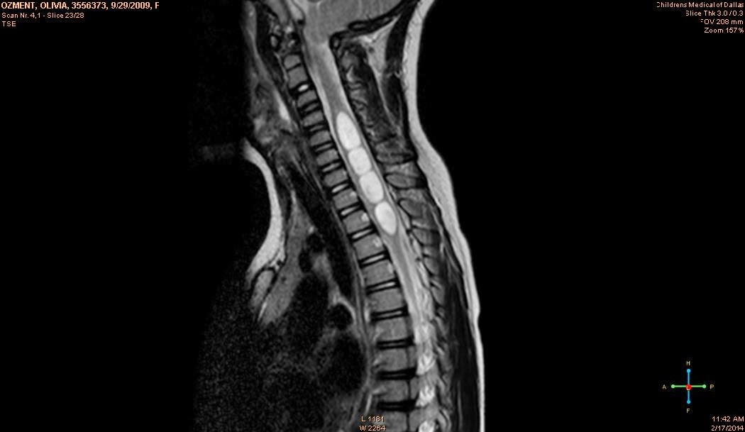 Children's Chiari Journal: CSF Flow Study part 1