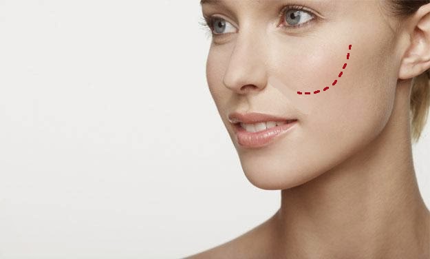 Alta Medicina Estética: Los pómulos marcados y el aspecto felino ...