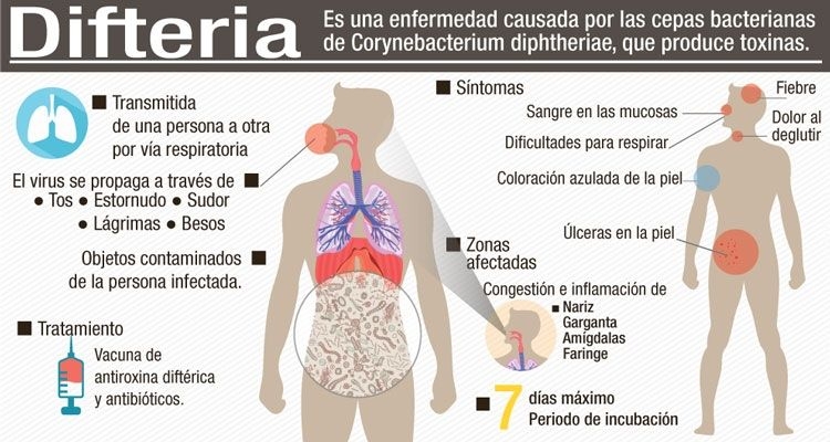 Dolor de garganta, principal síntoma de la Difteria