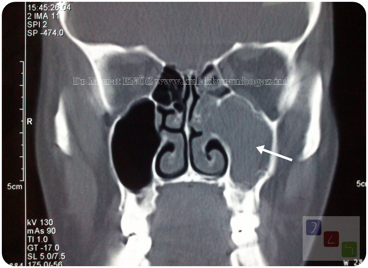 Endoscopic Sinus Surgery